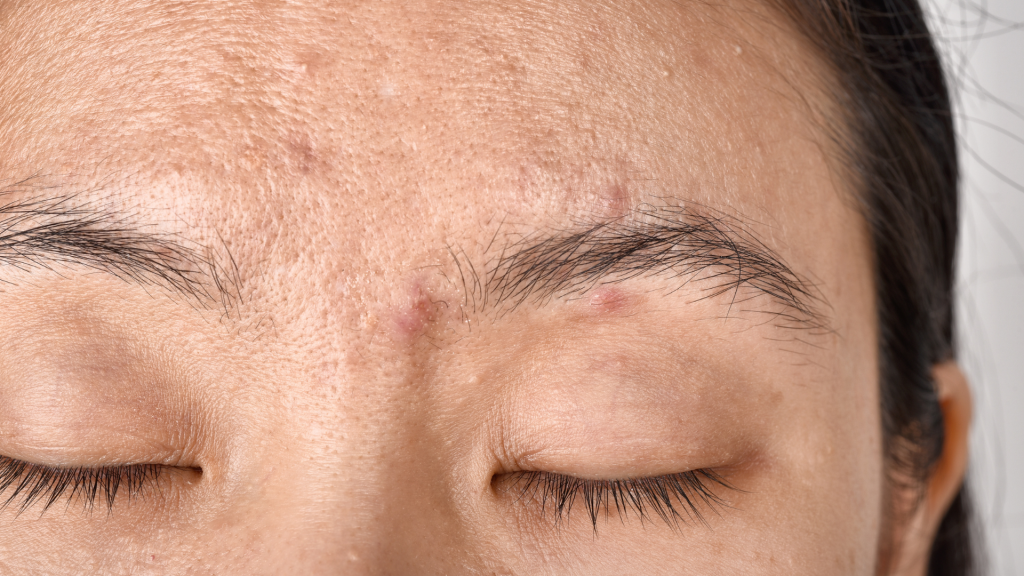Summer Skin Problems You Might Encounter - iCare Top Affordable HMO ...